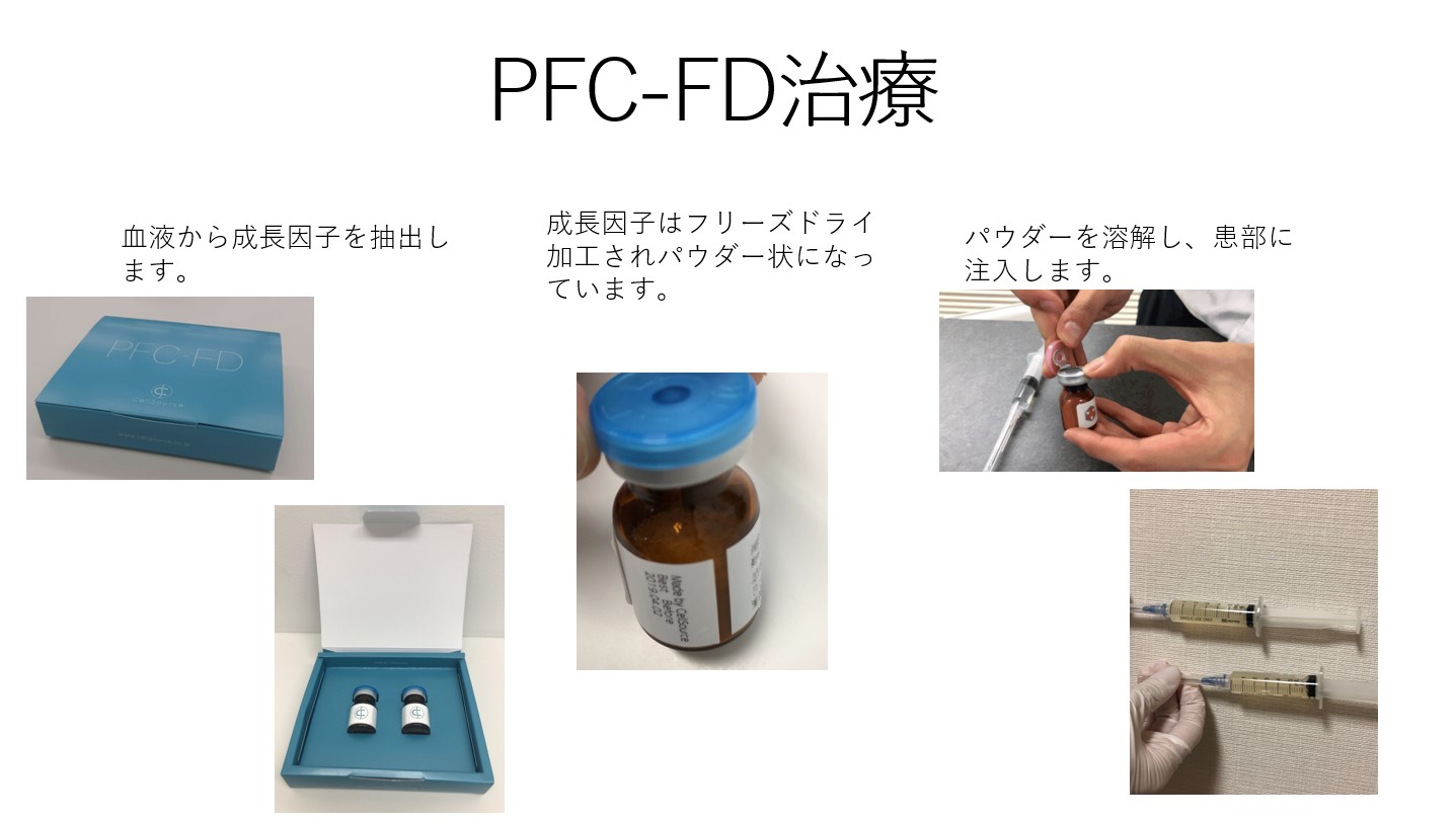 PFC-FD™療法｜横浜市保土ヶ谷区のうなやま整形外科